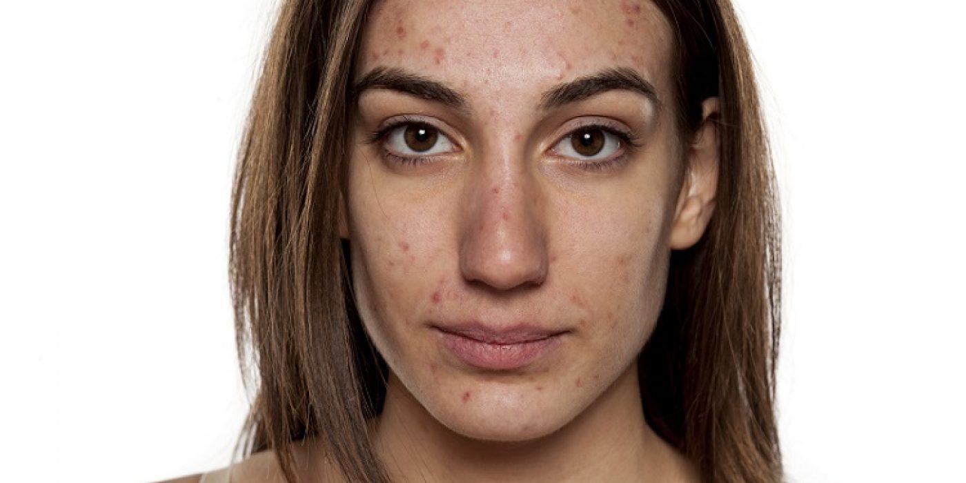Women Are Now Posting Their Acne Bare-Faces Because It's The Latest ...